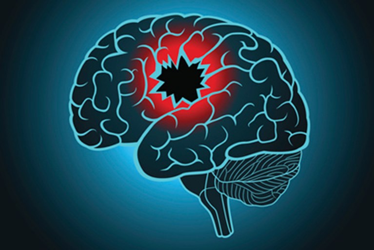 Podcast | Concussion and Mild Traumatic Brain Injury | Choose PT