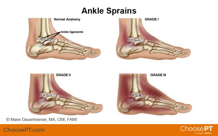 Guide Physical Therapy Guide To Ankle Sprain Choose PT