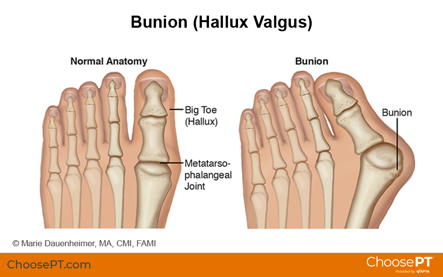 Guide Physical Therapy Guide To Bunion Hallux Valgus Choose PT Guide Physical Therapy Guide To Bunion Hallux Valgus Choose PT