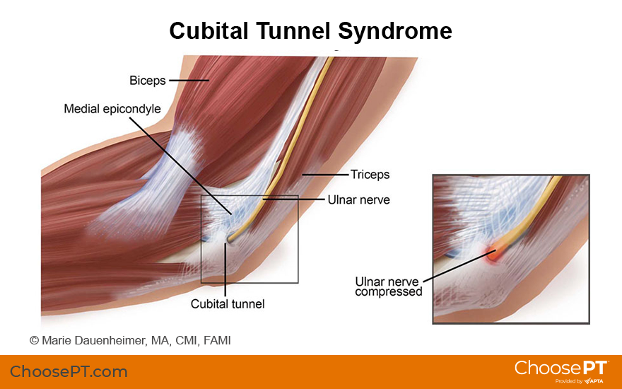 Sndrome Do Tnel Cubital Ulnar Nervo Ulnar Nervo Trceps